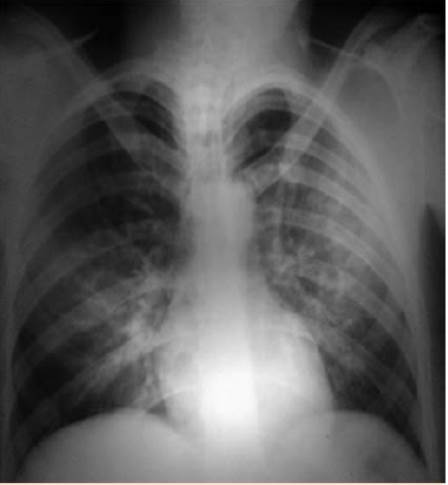 Edema Pulmonar Cardiogénico Rayos X