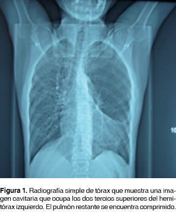 Cavernas pulmonares gigantes cicatrizadas, no colapsadas que simulan ...