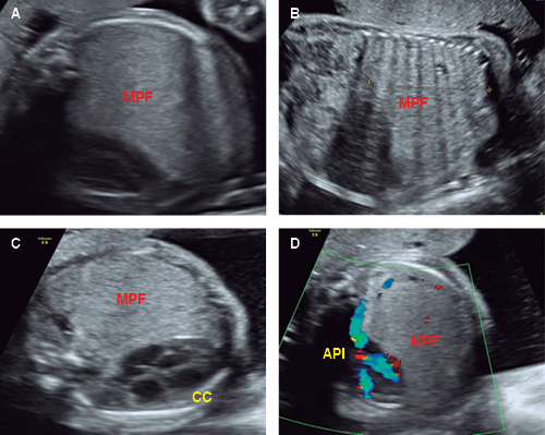 Procedimiento EXIT (ex utero intrapartum) en las malformaciones ...