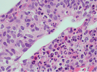 Granulomatosis eosinofílica con poliangitis: reporte de un caso y ...