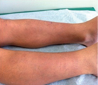 Granulomatosis eosinofílica con poliangitis: reporte de un caso y ...