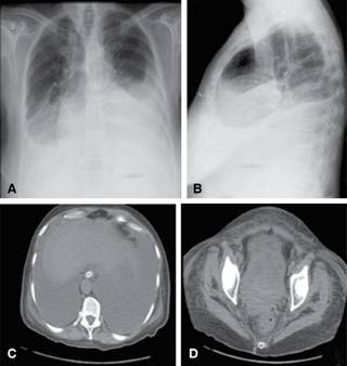 Pseudo-Meigs’ syndrome due to high-grade serous ovarian carcinoma