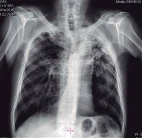 Topografía y patrones radiográficos de tuberculosis pulmonar en ...