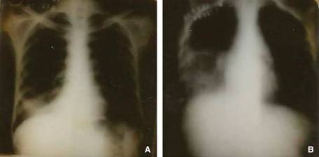Esophageal pulmonary fistula associated with lung cancer-autopsy study