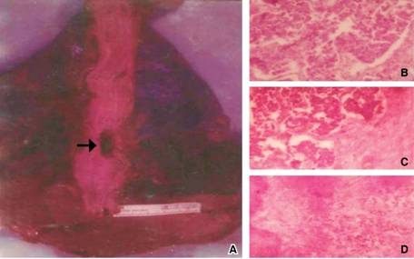 Esophageal pulmonary fistula associated with lung cancer-autopsy study