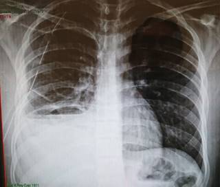 Quilotórax traumático y su resolución quirúrgica, una entidad poco ...