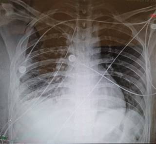 Quilotórax traumático y su resolución quirúrgica, una entidad poco ...