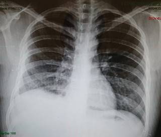 Quilotórax traumático y su resolución quirúrgica, una entidad poco ...