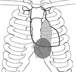 La clínica en la hipertensión pulmonar del adulto