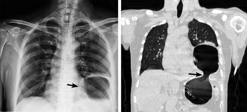 Lesión diafragmática por trauma penetrante y manifestación tardía con ...