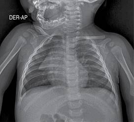 Radiografía de tórax en pediatría.Una interpretación sistematizada