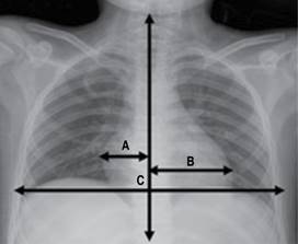 Radiografía de tórax en pediatría.Una interpretación sistematizada