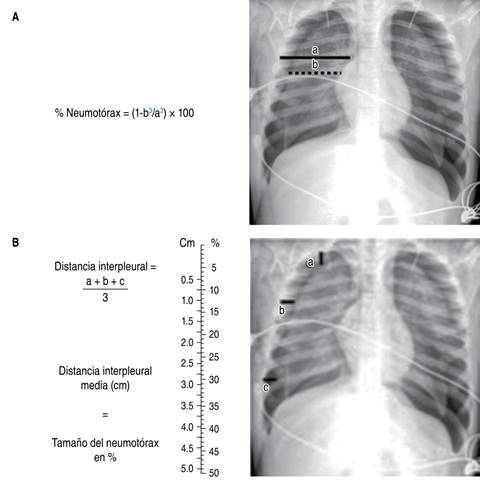 Radiografía de tórax en pediatría.Una interpretación sistematizada