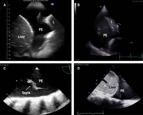Utility of Balik’s formula for the quantification of pleural effusion ...