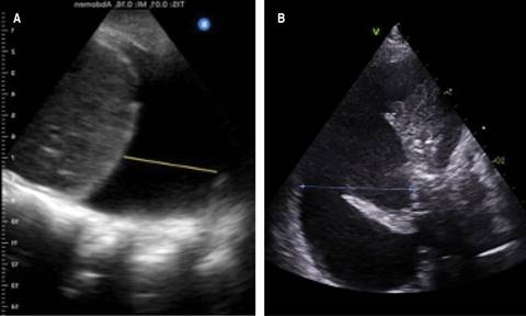 Utility of Balik’s formula for the quantification of pleural effusion ...