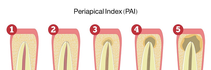 Radiographic characteristics in the periapical healing post endodontic ...