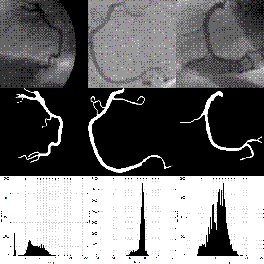 Automatic segmentation of coronary arteries using a multiscale Top-Hat ...