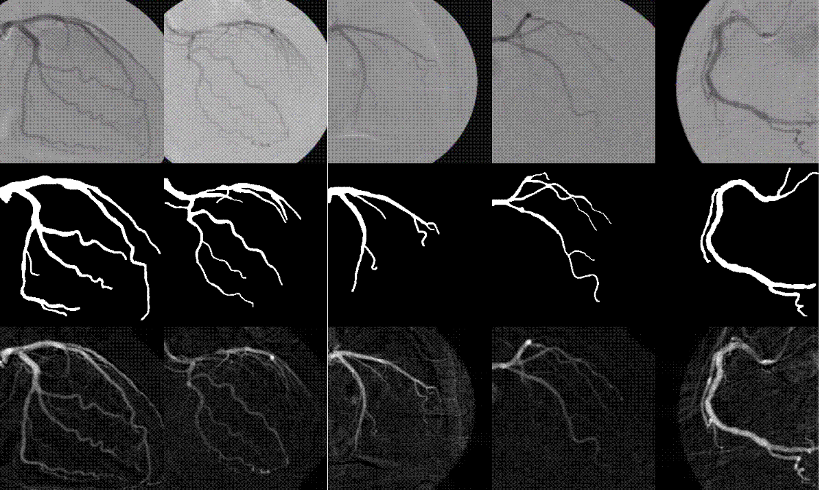 Automatic segmentation of coronary arteries using a multiscale Top-Hat ...