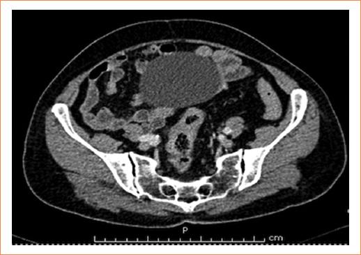 Presentación atípica del síndrome de Meigs: reporte de caso y revisión ...