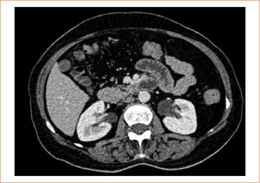 Presentación atípica del síndrome de Meigs: reporte de caso y revisión ...