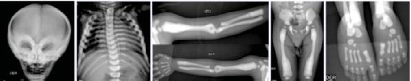 Identificación de nuevas mutaciones en TCIRG1 como causa de ...