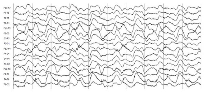 Aspectos neuropsiquiátricos de la encefalitis por anticuerpos contra el ...