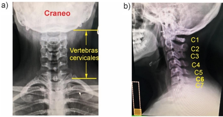 Huesos De La Anatomía Del Cuello
