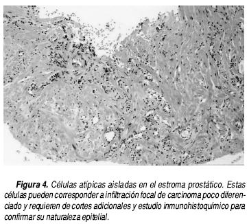Hallazgos patológicos en 100 biopsias prostáticas por punción y ...