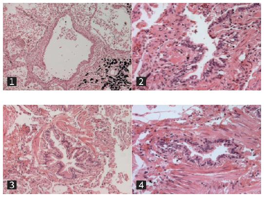 Small Airway Disease in COPD Associated to Biomass Exposure
