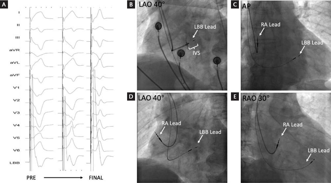 Quantification of Acute Myocardial Damage Secondary to Implantation of ...