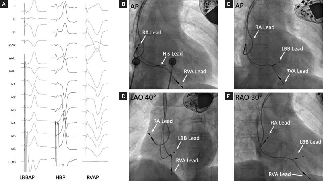 Quantification of Acute Myocardial Damage Secondary to Implantation of ...