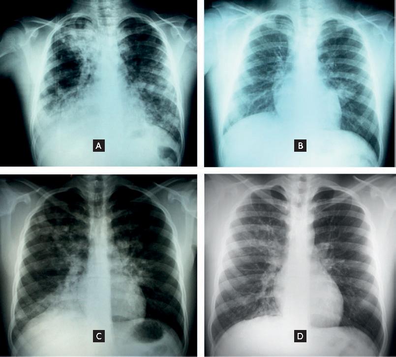 Impact of Moderate Altitude on Lung Diseases and Risk of High Altitude ...
