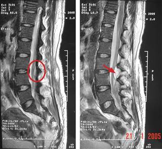 Absceso epidural en una paciente obstétrica