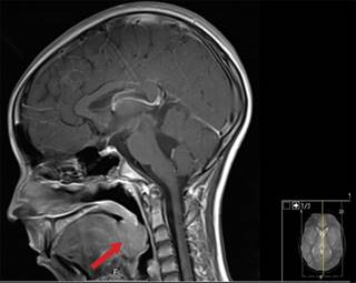 Lingual Tonsils Model