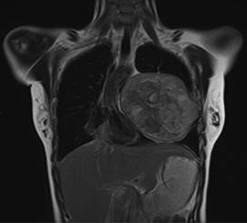Consideraciones anestésicas en pacientes sometidos a cirugía para ...