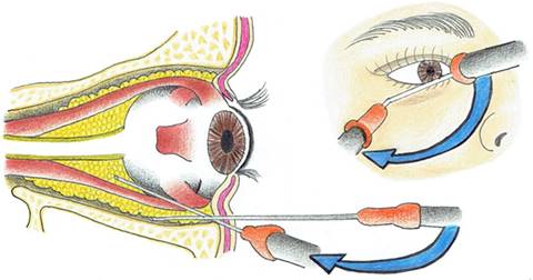 Anestesia del tronco encefálico posterior a bloqueo retrobulbar en ...
