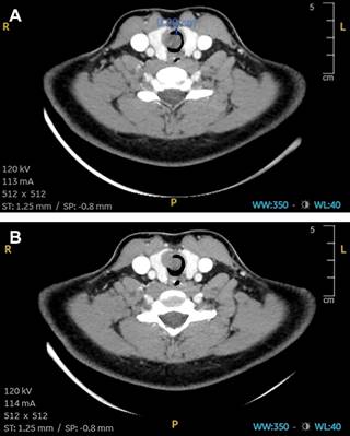 Successful prehospital airway management in a patient with severe ...