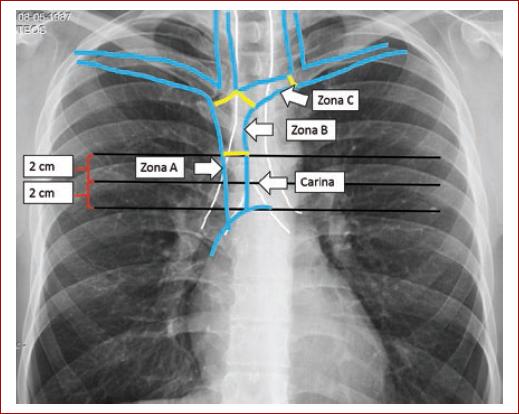 Validación de una medida estandarizada en la longitud de inserción del ...