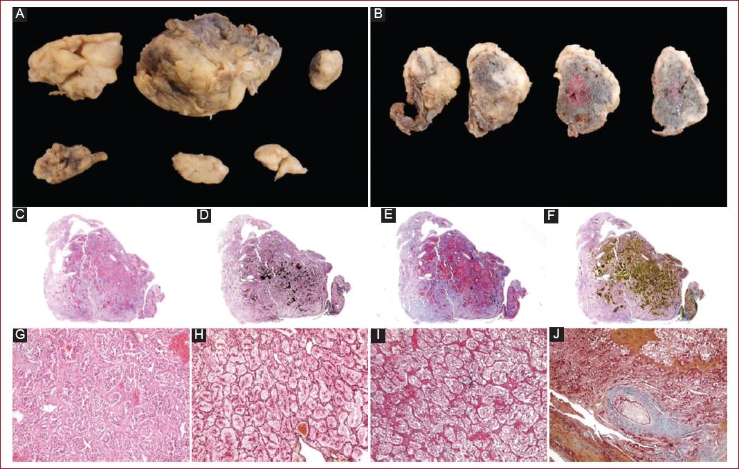 Technique modification proposal for carotid body tumors resection ...