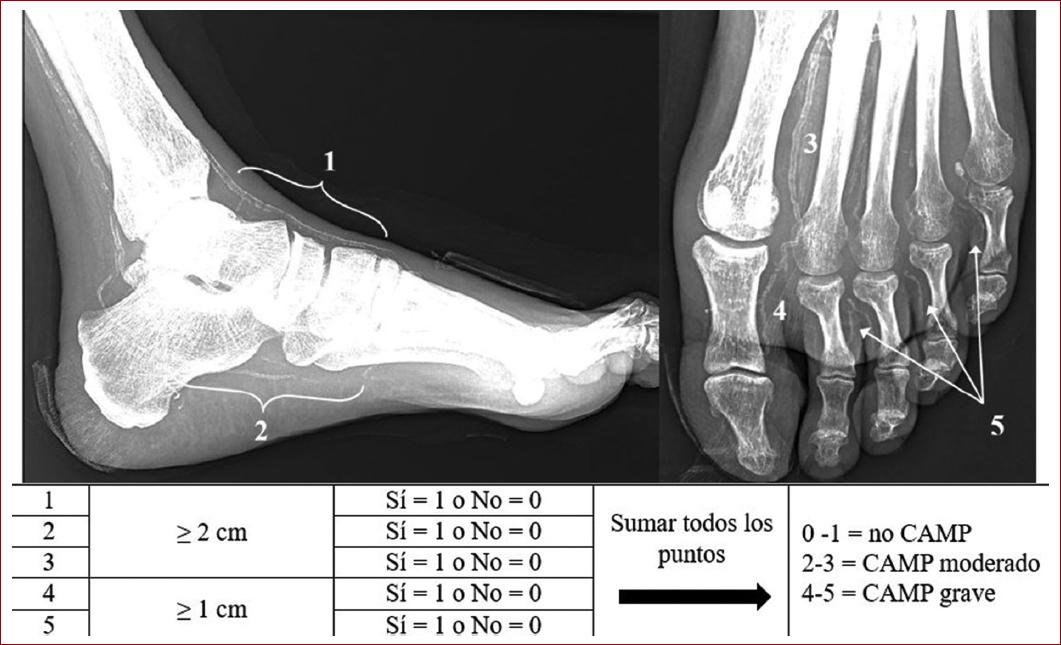 Calcificación arterial de la capa media en el pie y riesgo de ...