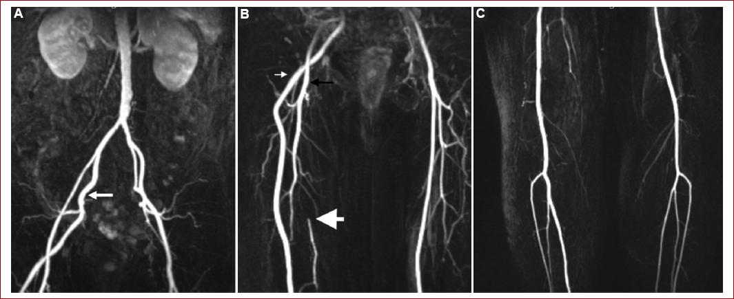 Popliteal artery acute thromboembolic ischemia from a persistent ...