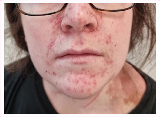 MEK inhibitors in maintenance of a postoperative patient with ...