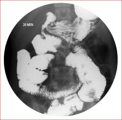 Síndrome de Wilkie: a razón de un caso