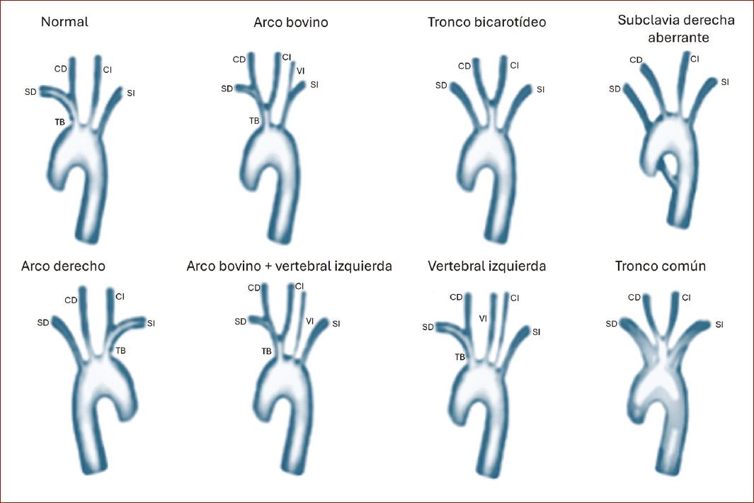 Variantes anatómicas del arco aórtico asociadas a progresión y ...
