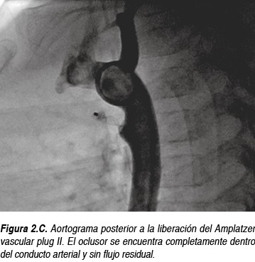 Cierre percutáneo del conducto arterioso permeable en niños utilizando ...
