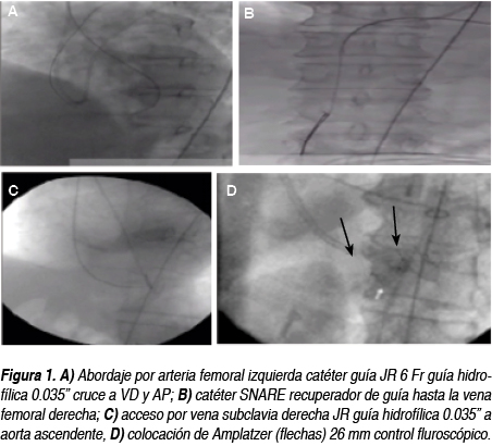 Cierre percutáneo primario del defecto del tabique interventricular ...