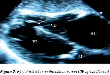 Cierre percutáneo primario del defecto del tabique interventricular ...