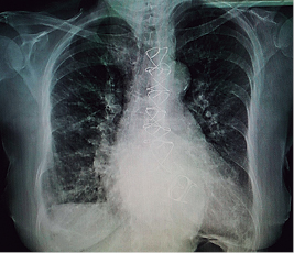 Transcatheter transapical mitral valve-in-valve implantation: case report