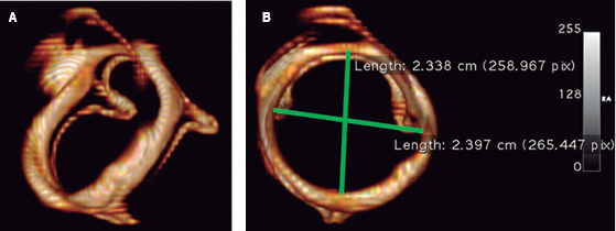 Transcatheter transapical mitral valve-in-valve implantation: case report