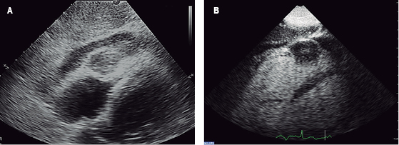 Intramyocardial dissecting hematoma of the right ventricle secondary to ...